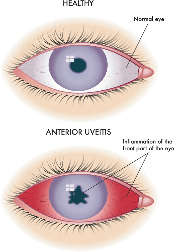 Uveitis Treatment Fort Worth Ophthalmology Associates Uveitis Treatment Fort Worth Ophthalmology Associates