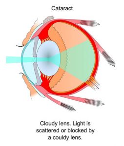 Frequently Asked Questions: Cataract Surgeon - Fort Worth