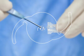 Choosing the Right Cataract Lens | Ophthalmology Associates